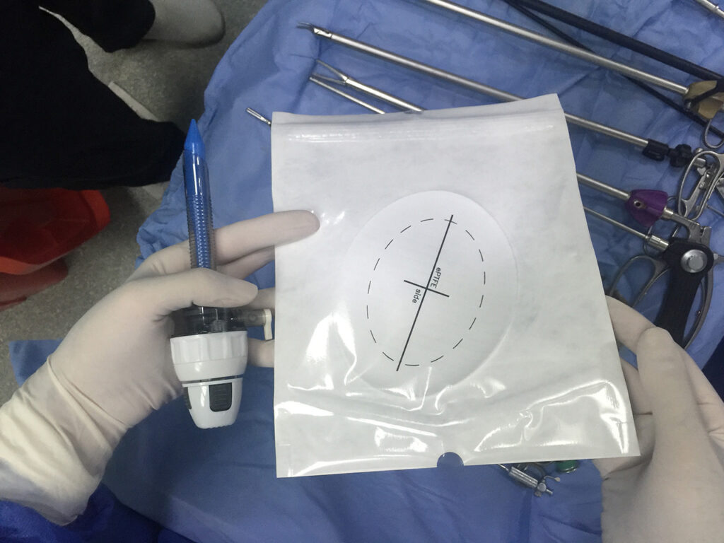 Laparoscopic Umbilical Hernia Repair 2 Dr Raad Al Saffar